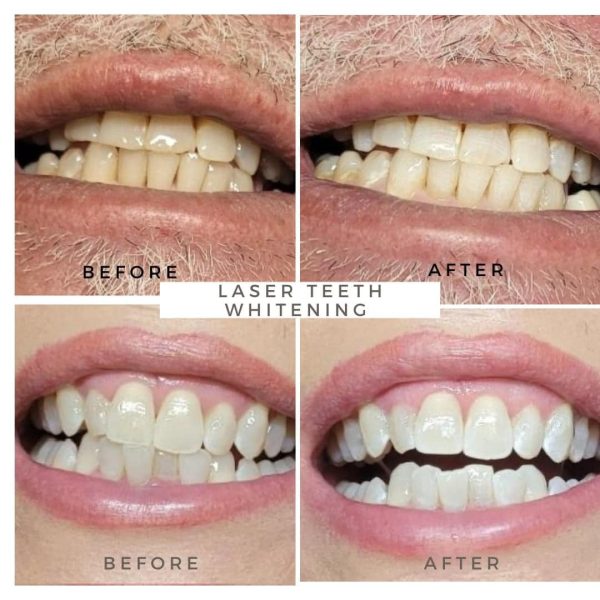 Laser Teeth Whitening Odessa | Teeth Whitening Service Odessa