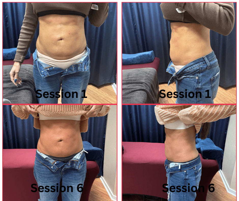 Body Contouring in Odessa, TX | Cavitation & RF Treatments | Slim’s ...